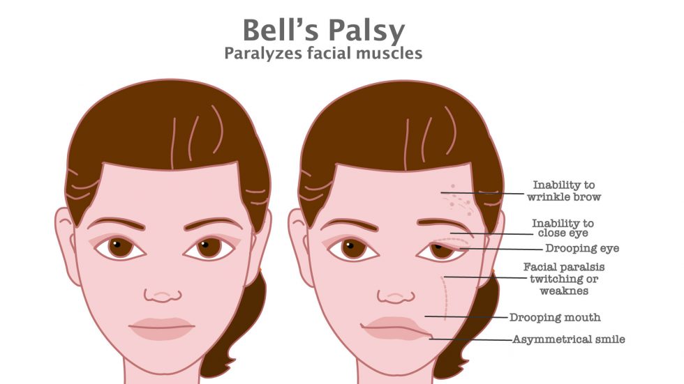 Bell’s Palsy: Understanding Facial Muscle Weakness and Role of ...